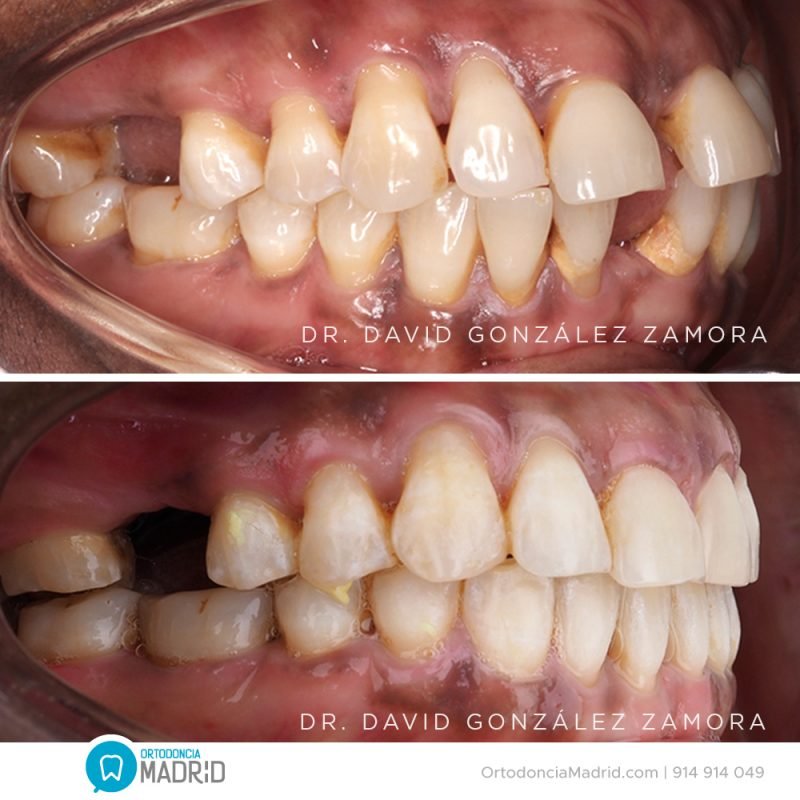 Diastema · Biprotrusión • Ortodoncia Madrid