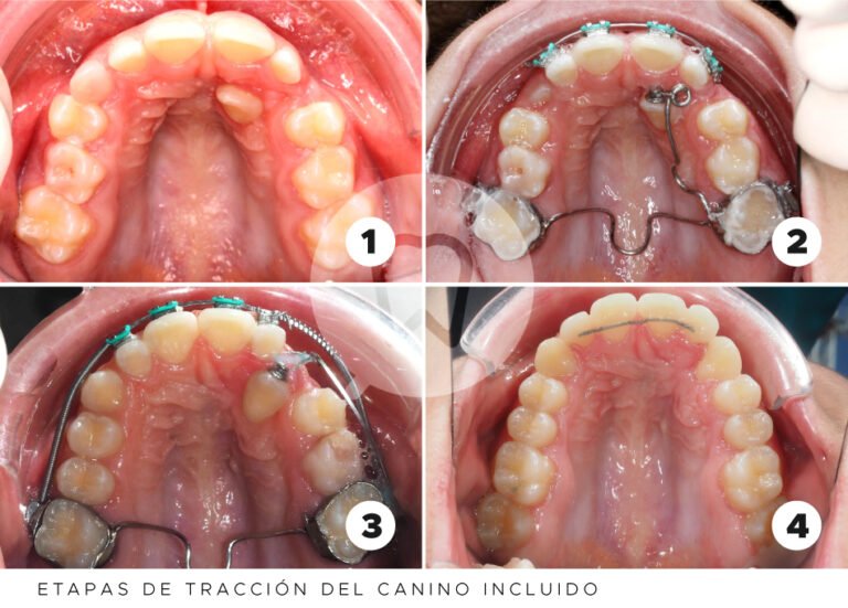 Qué es un diente incluido • Ortodoncia Madrid