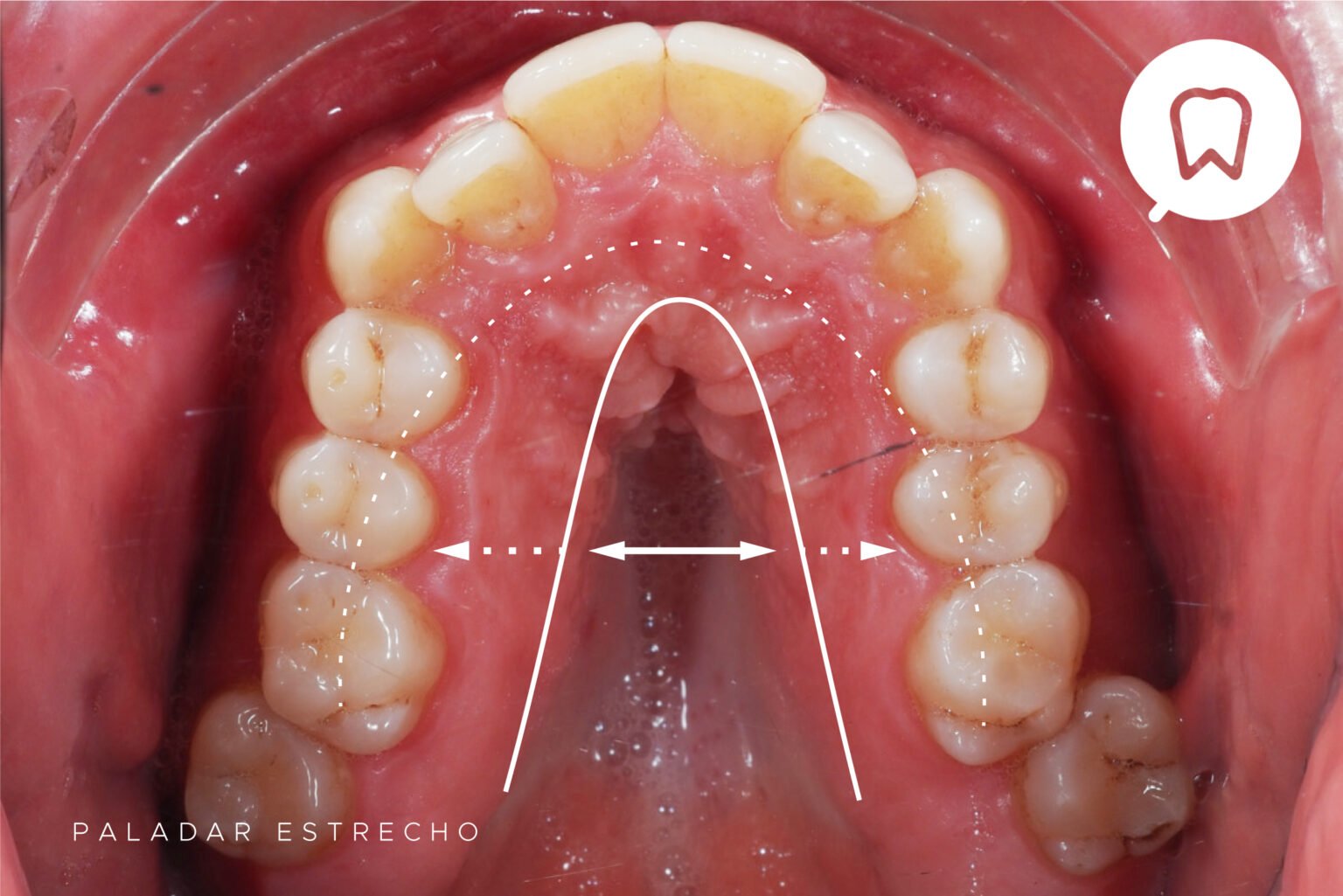 Paladar estrecho: todo lo que debes saber • Ortodoncia Madrid