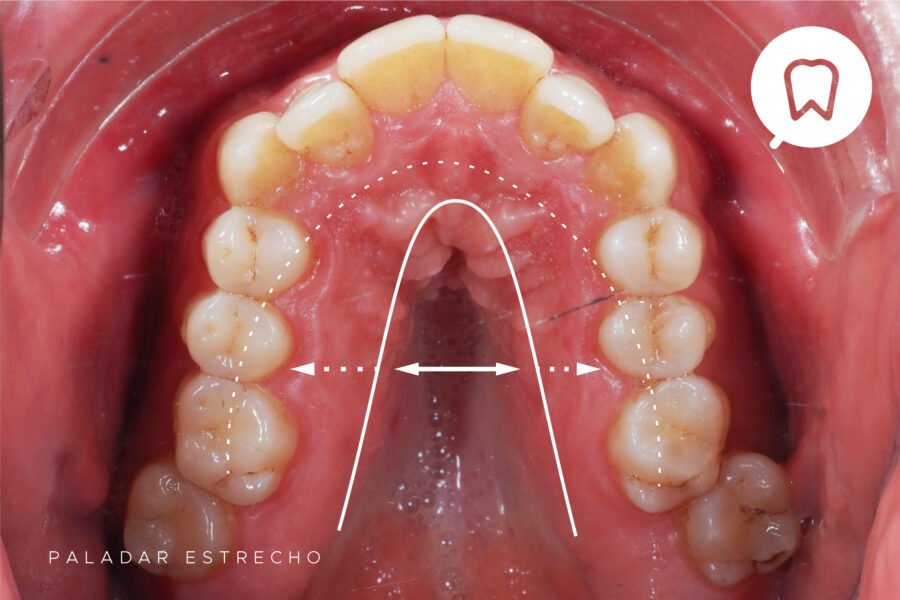 Paladar estrecho: todo lo que debes saber • Ortodoncia Madrid