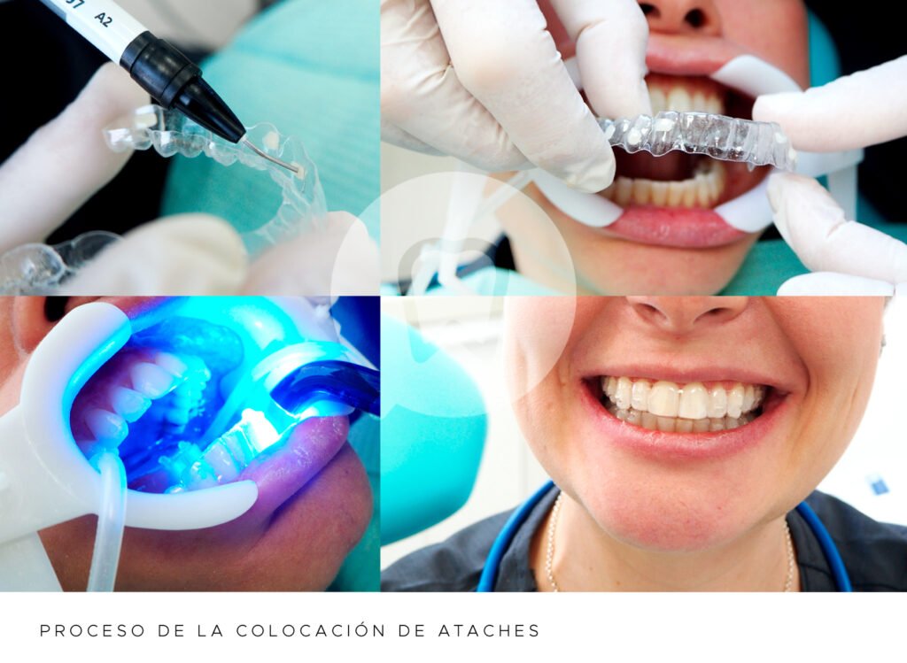 Qué son los ataches en ortodoncia invisible • Ortodoncia Madrid